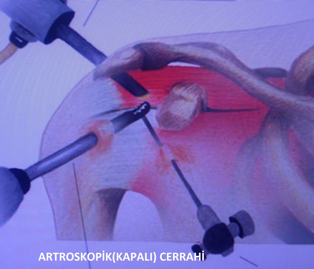 Omuzun Kalsifik Tendinit'i - Prof. Dr. Özgür ÇETİK